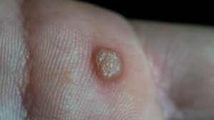 Verrucaes/Warts – Podiatry Kenya